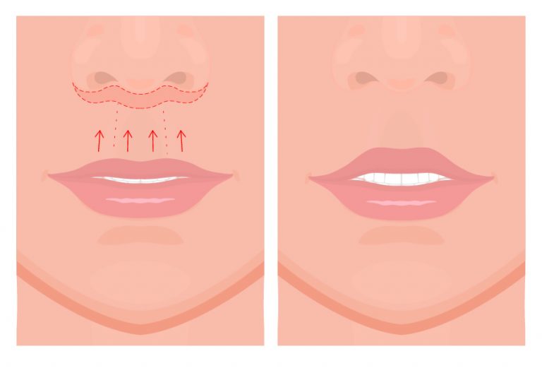 Aumento de labios definitivo en Zaragoza – Lip Lift – Dr. Terré