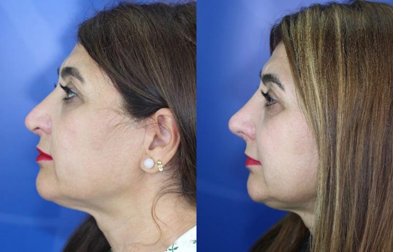 Rinoplastia para nariz ancha - Dr. Ramón Terré