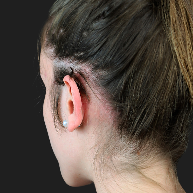 Todo sobre la fibrosis tras una rinoplastia - Ramón Terré