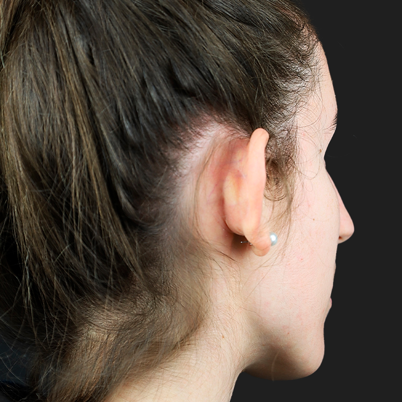 Todo sobre la fibrosis tras una rinoplastia - Ramón Terré